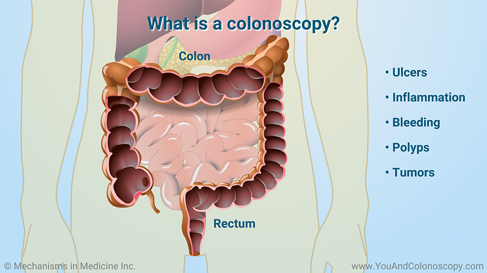 What happens during and after a colonoscopy?